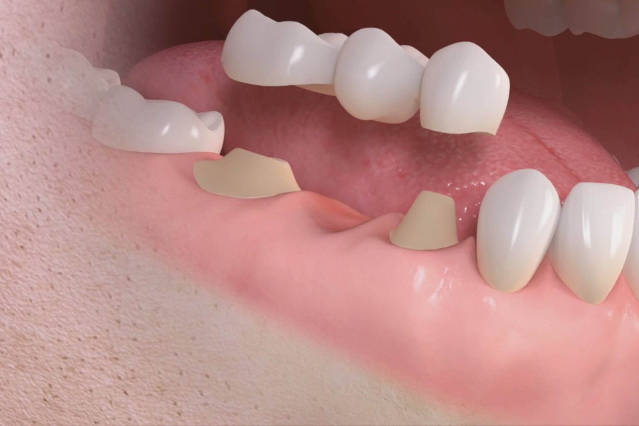 Todo Lo Que Necesitas Sobre La Prótesis Fijas | Dr Eduardo COLL